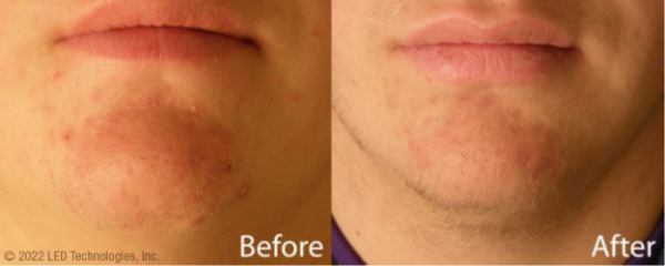 Blue Light Therapy for Acne - Consumer Study