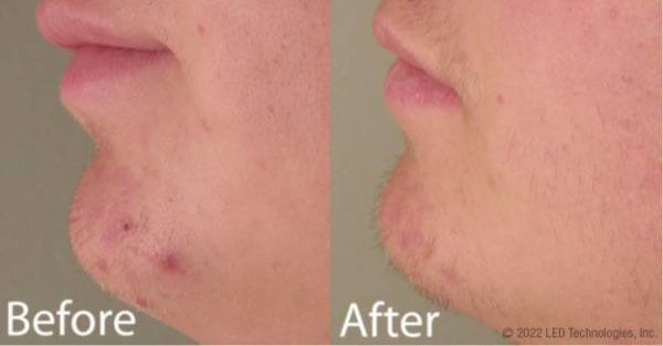 Blue Light Therapy for Acne - Consumer Study