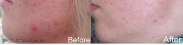 Blue Light Therapy for Acne - Consumer Study